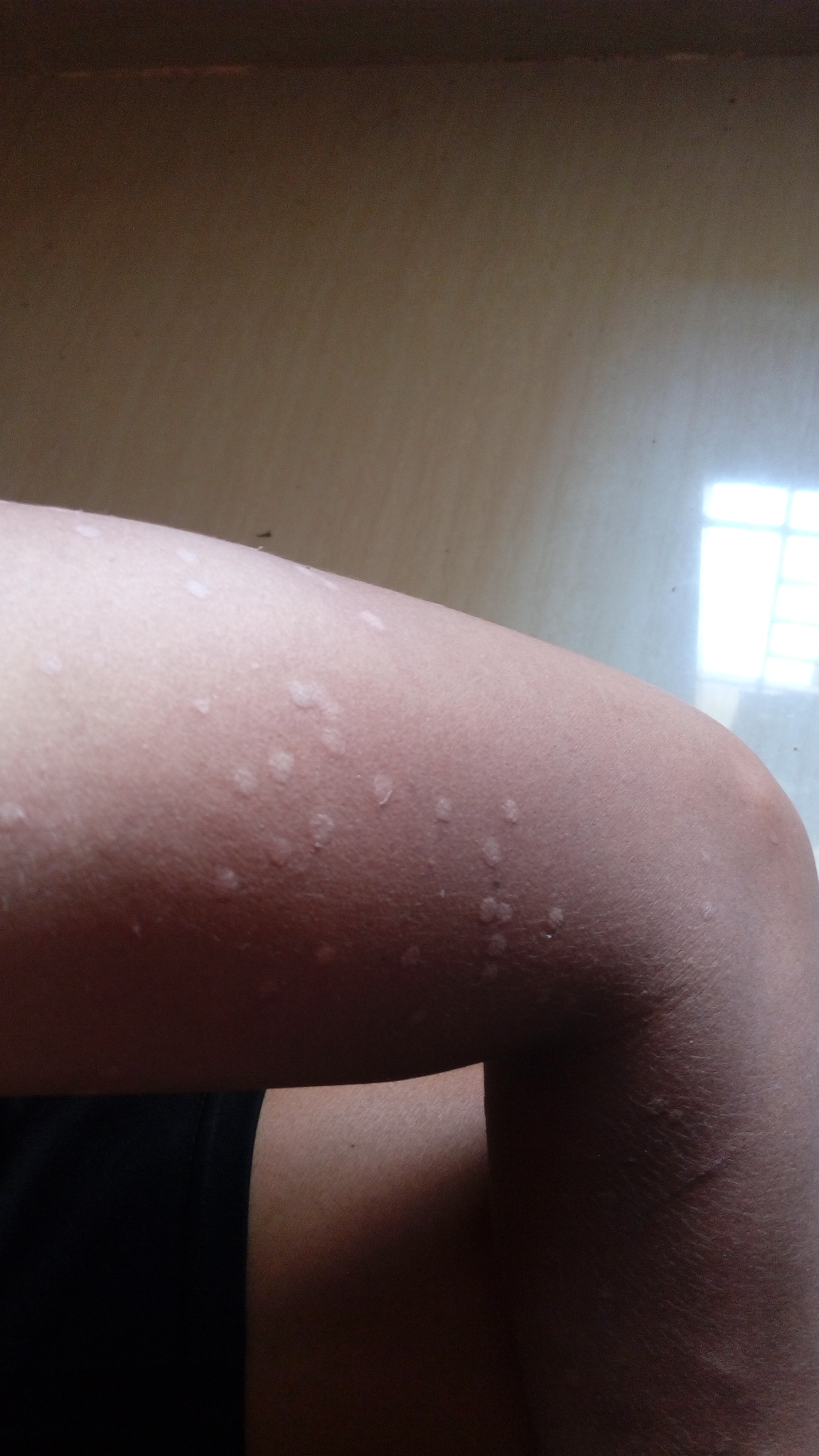 Penyebab Bintik Bening Berair Gatal di Tangan • Hello Sehat