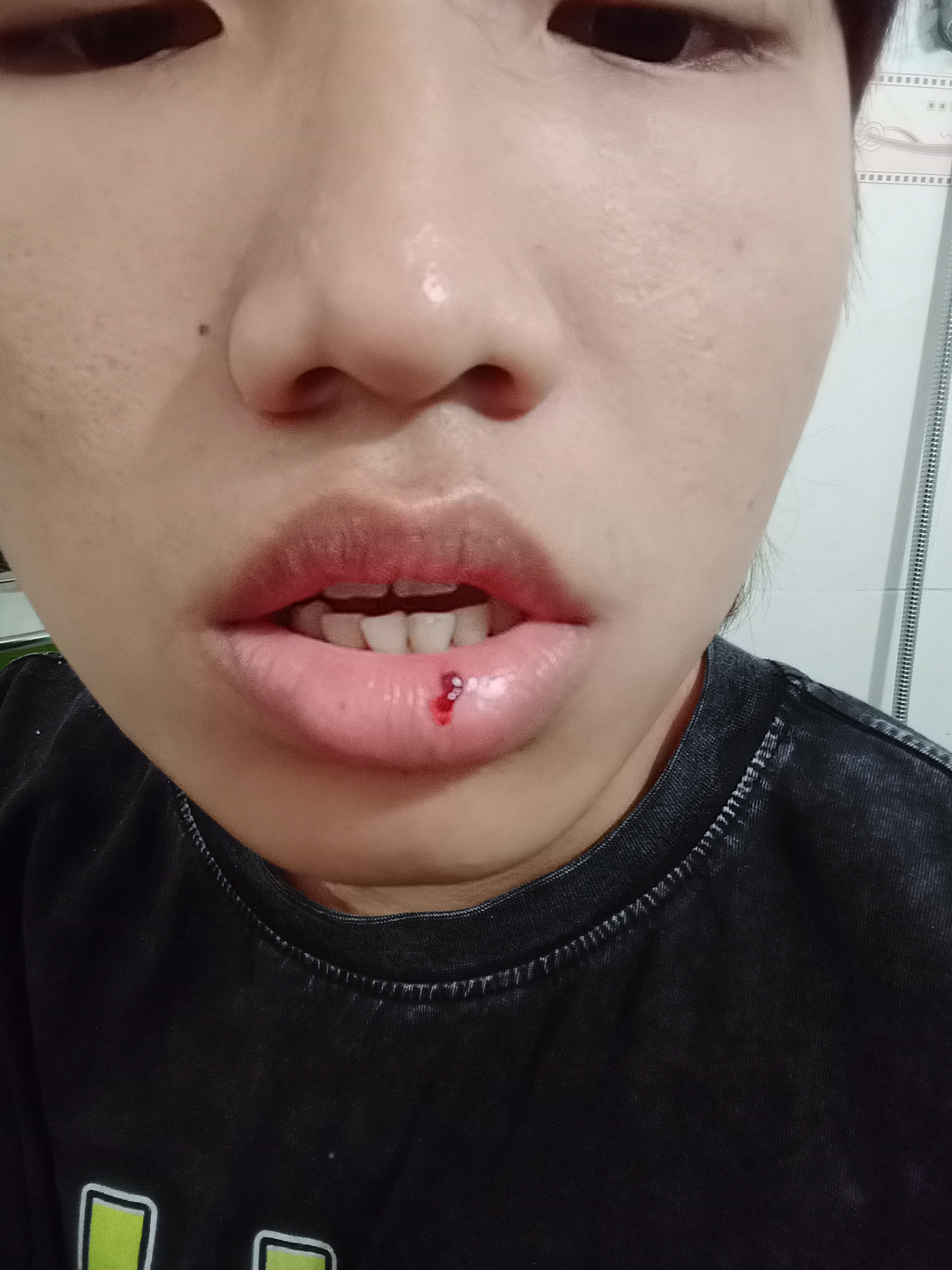 Con mới thức dậy thì thấy môi có nổi 1 bọc máu không đau - HelloBacsi